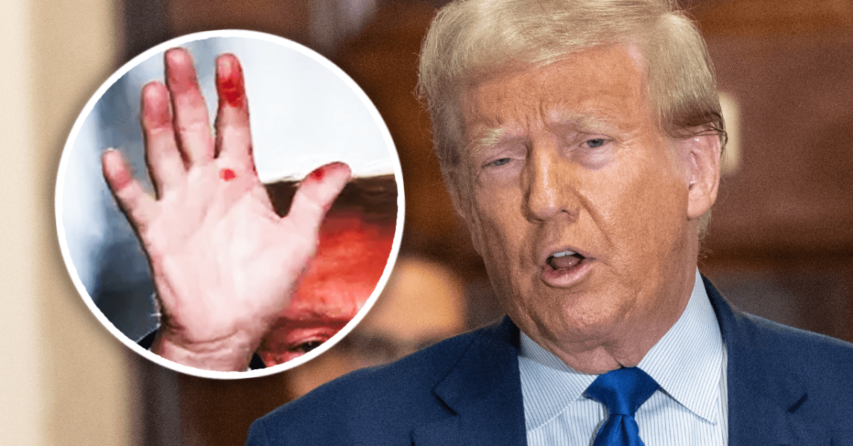 Carville: It Appears That Trump Has Secondary Syphilis - MeidasTouch News